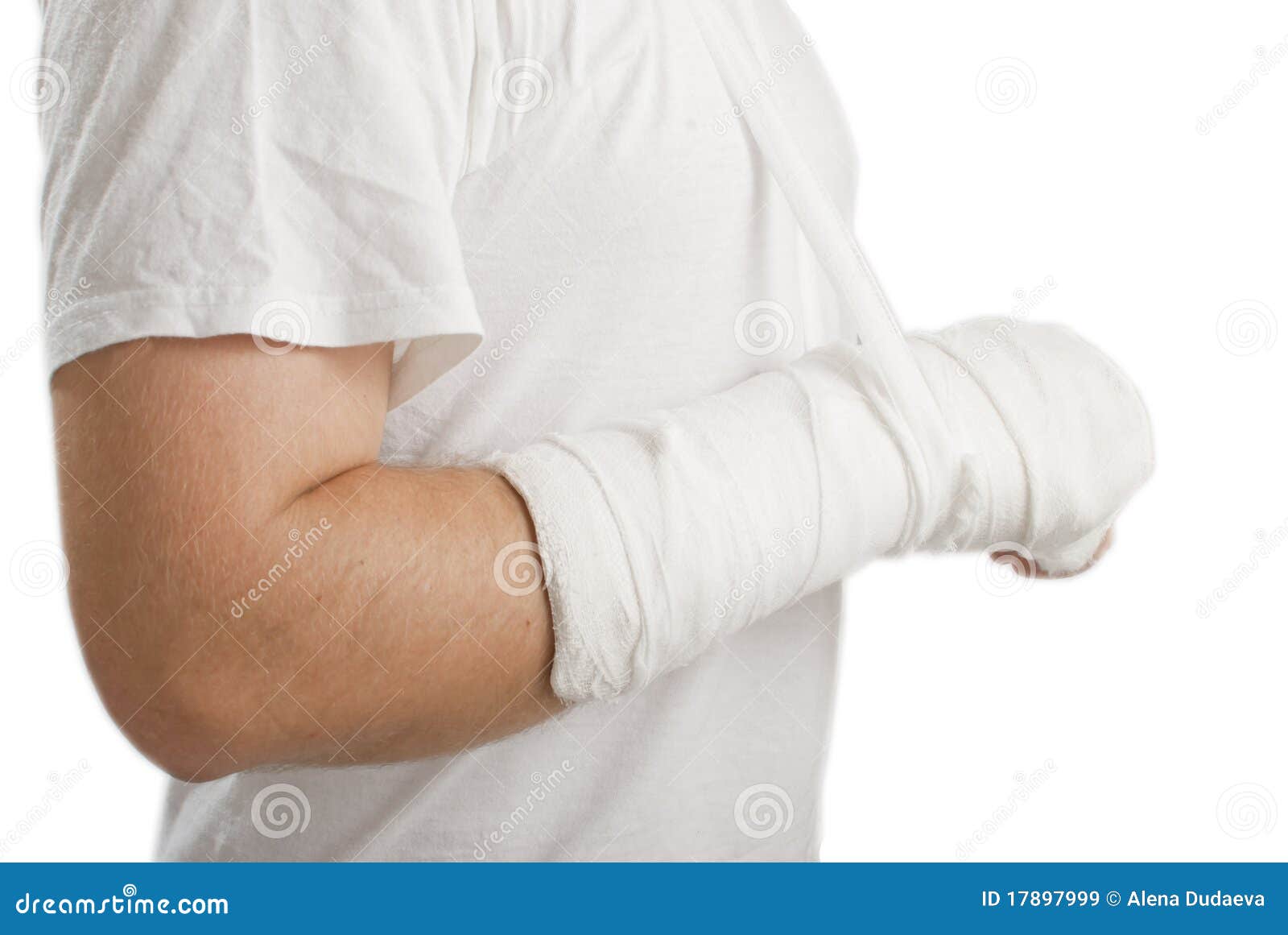 Man with a broken hand stock image. Image of plaster - 17897999