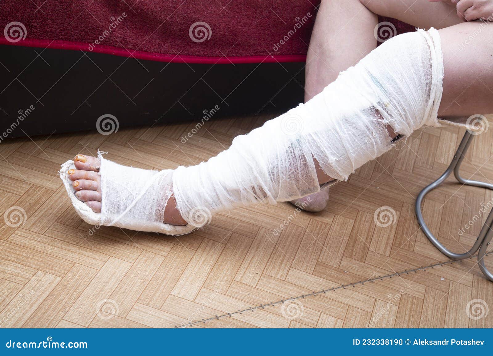 A Man with a Broken Leg.a Cast on a Man`s Leg Stock Photo - Image of ...