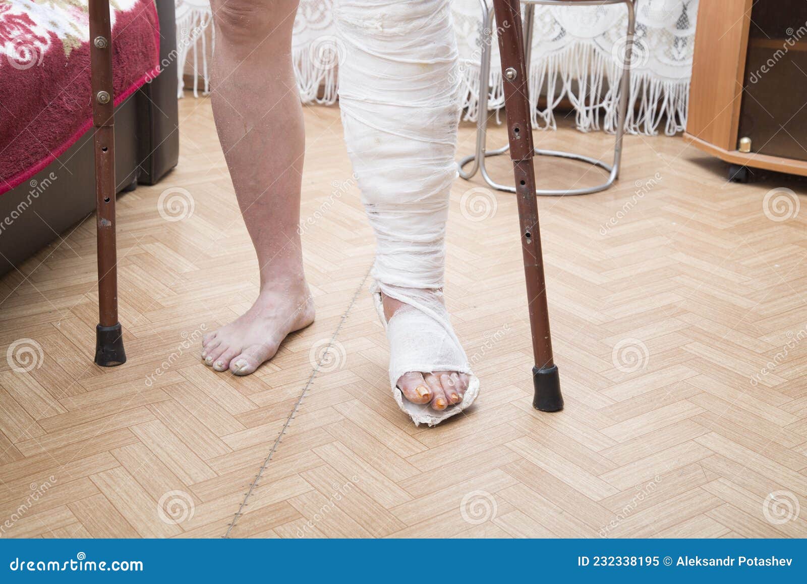 A Man with a Broken Leg.a Cast on a Man`s Leg Stock Image - Image of ...