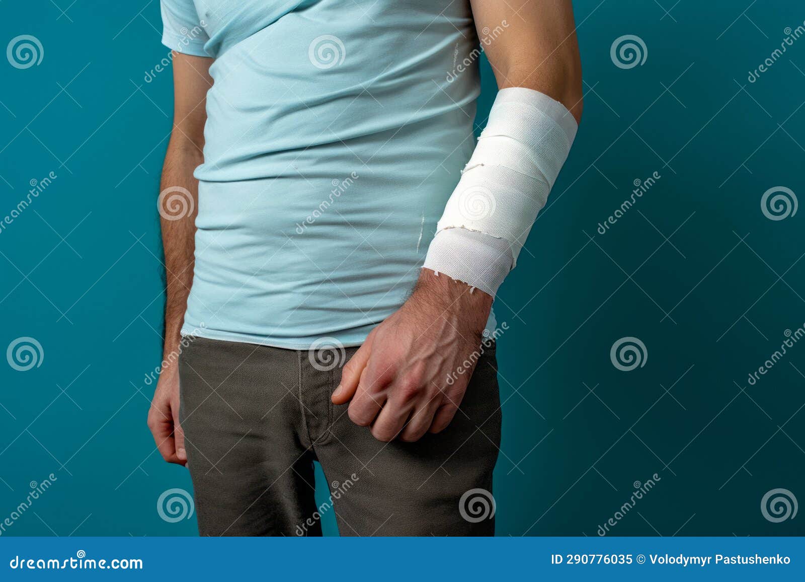 Man with Cast on His Arm and Cast on His Arm. Generative AI Stock Image ...