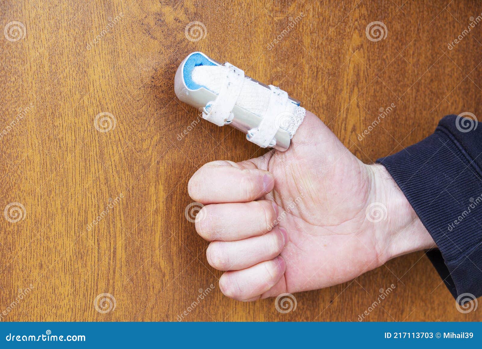 A Man with a Cast on His Broken Thumb. Safety at Work Stock Image ...