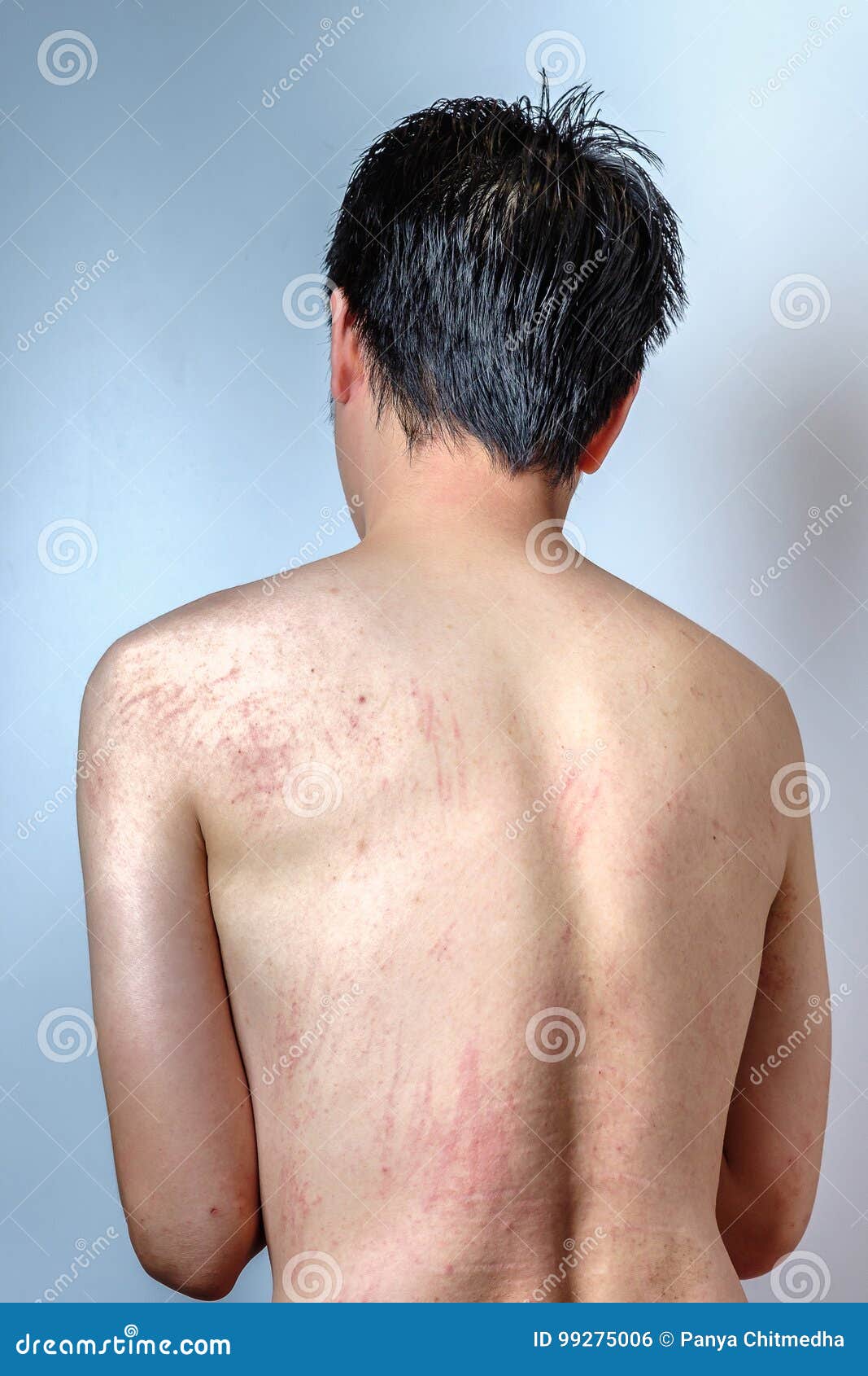 Man with Dermatitis Problem of Rash Stock Photo - Image of medical ...