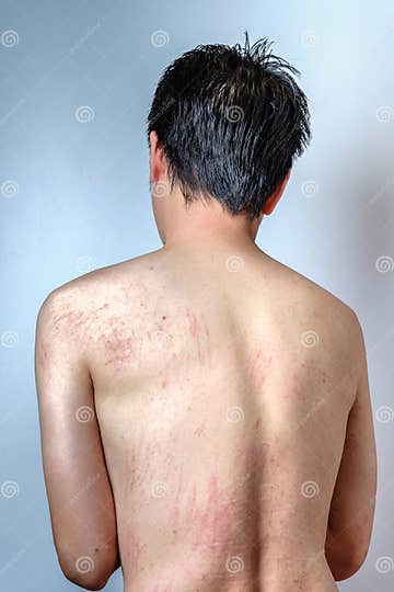 Man with Dermatitis Problem of Rash Stock Photo - Image of medical ...