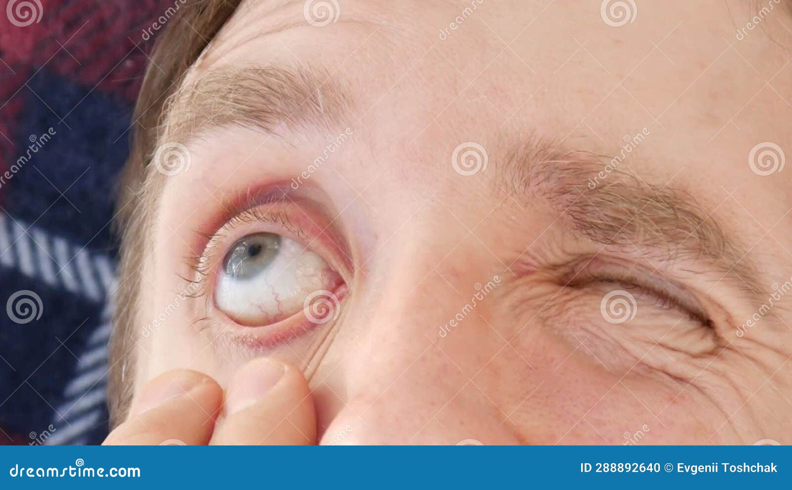 Close-up of the Eyes of a Man Dripping Eye Drops Stock Footage - Video ...