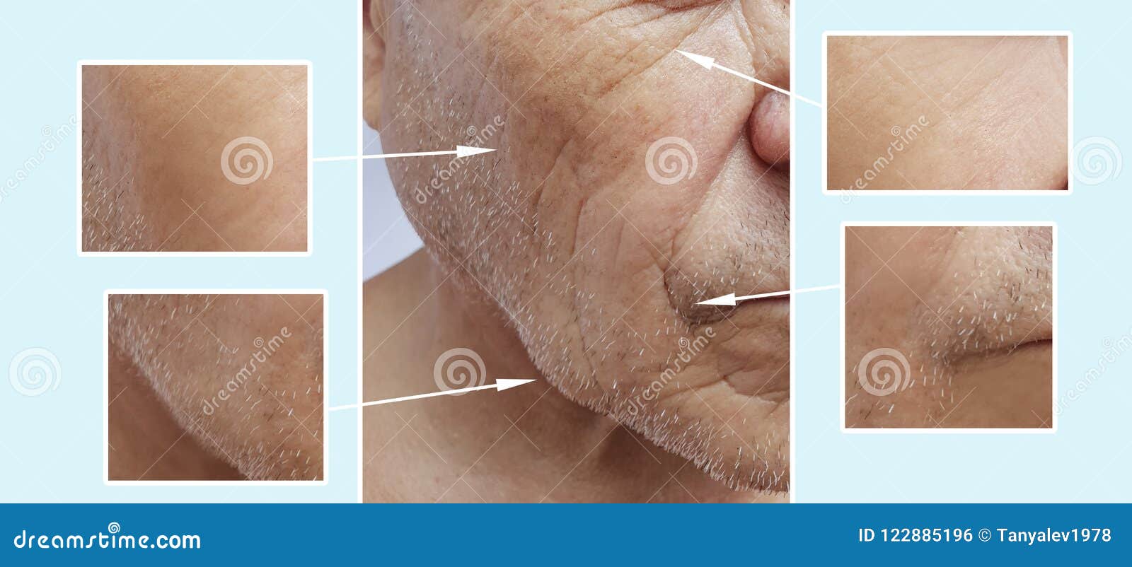 Man Elderly Face Wrinkles before and after Surgery Procedures Stock ...