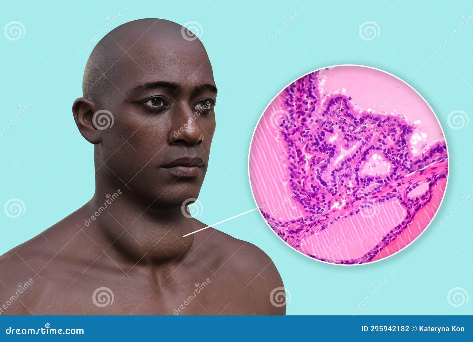 A Man with Enlarged Thyroid Gland, 3D Illustration, and Micrograph ...