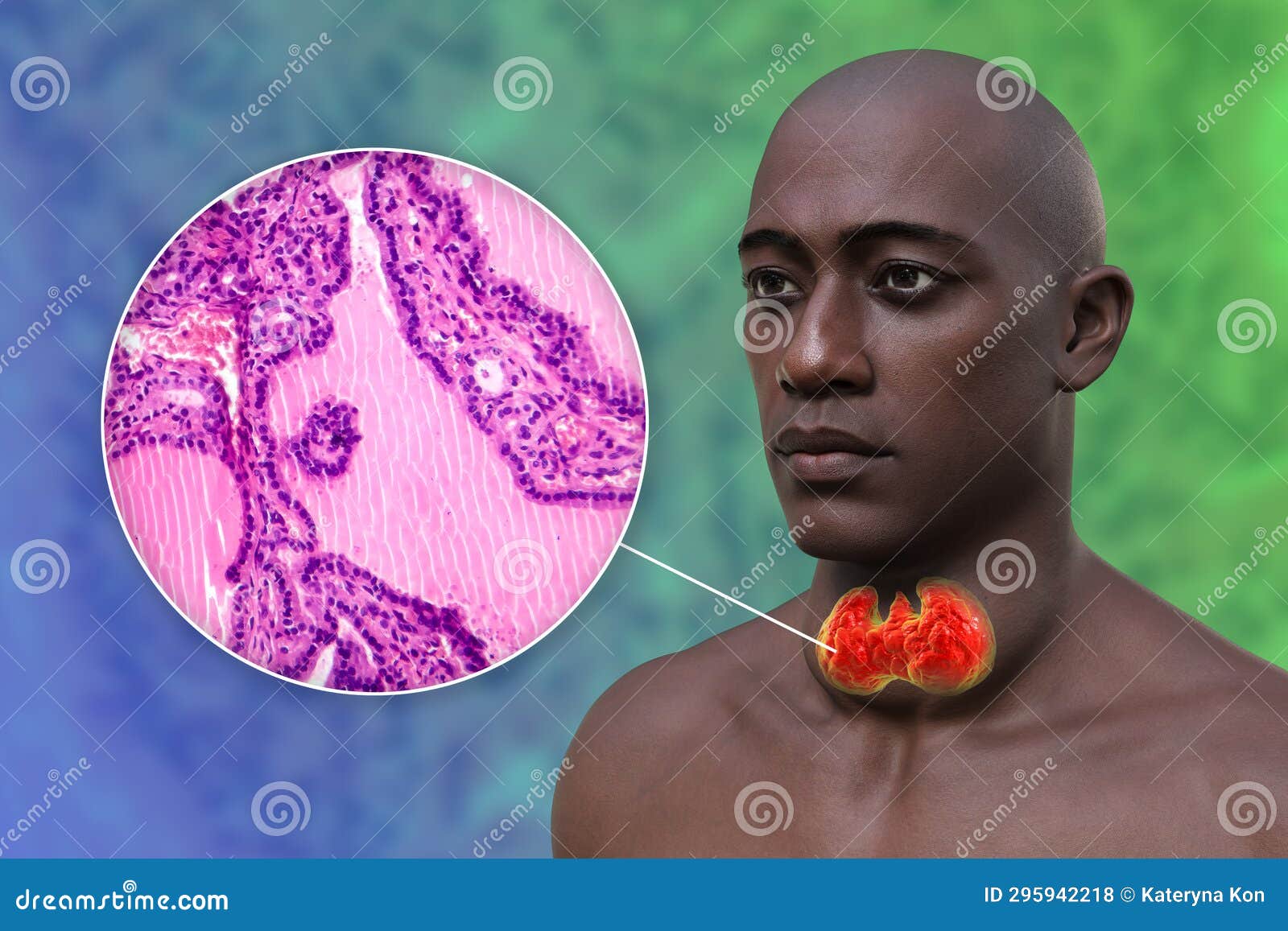A Man with Enlarged Thyroid Gland, 3D Illustration, and Micrograph ...