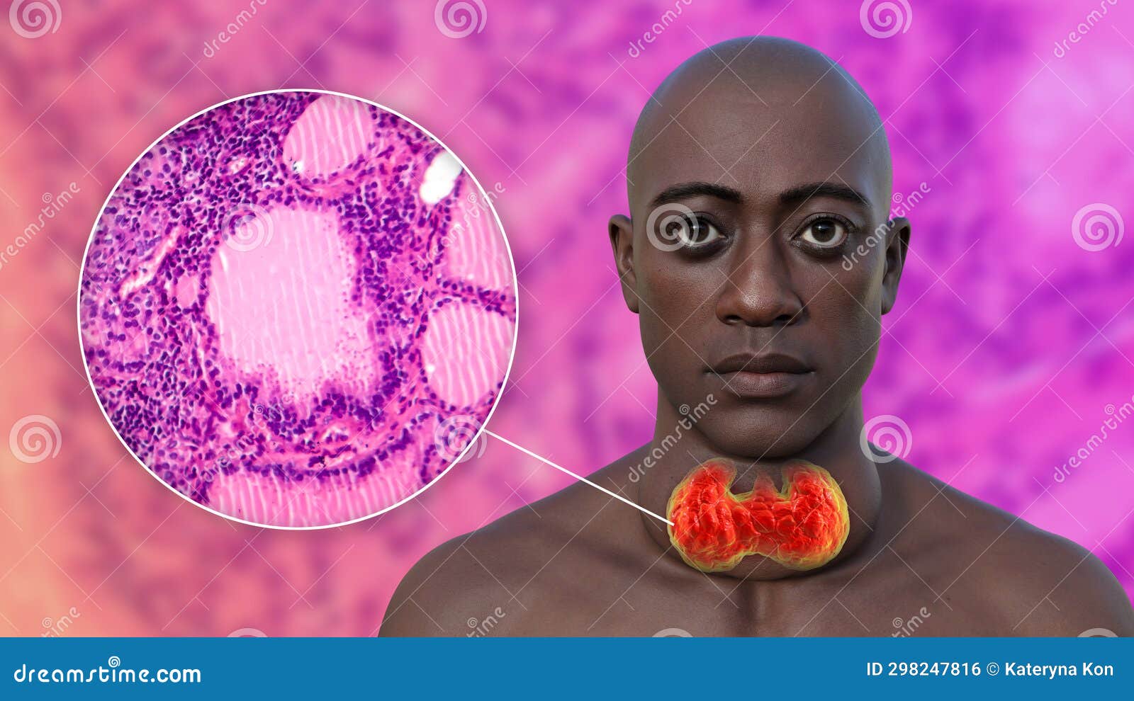 A Man with Enlarged Thyroid Gland, 3D Illustration, and Micrograph ...