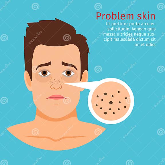 Man Face Skin Problem Black Dots Stock Vector - Illustration of ...