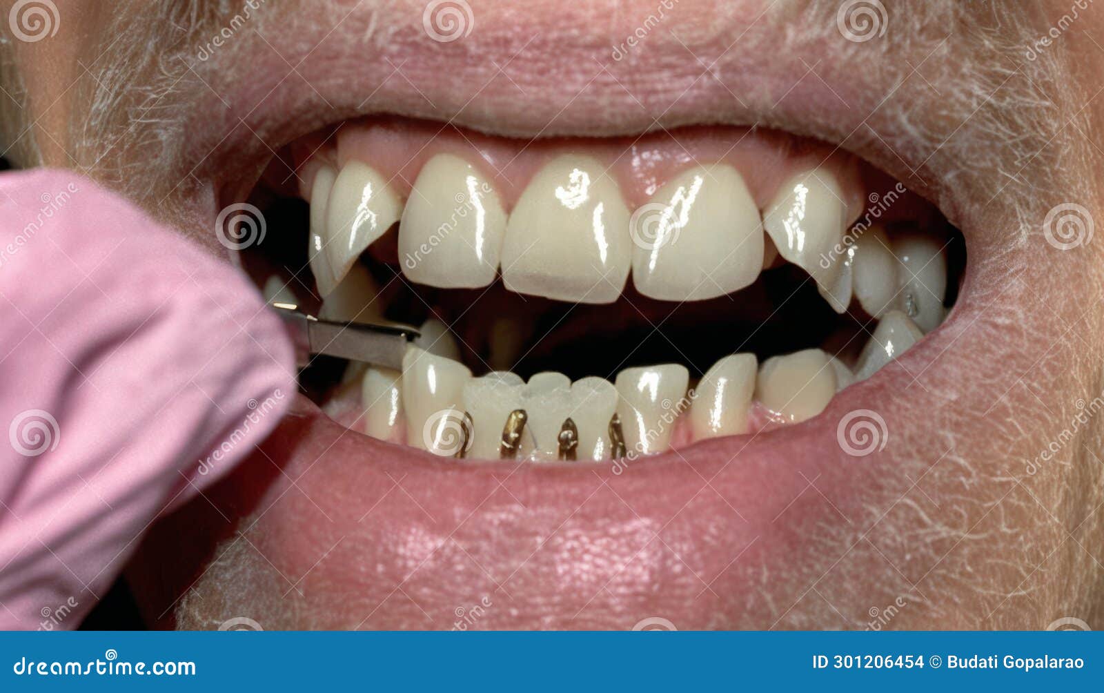 A Man with a Gold Tooth Grinning Stock Illustration - Illustration of ...