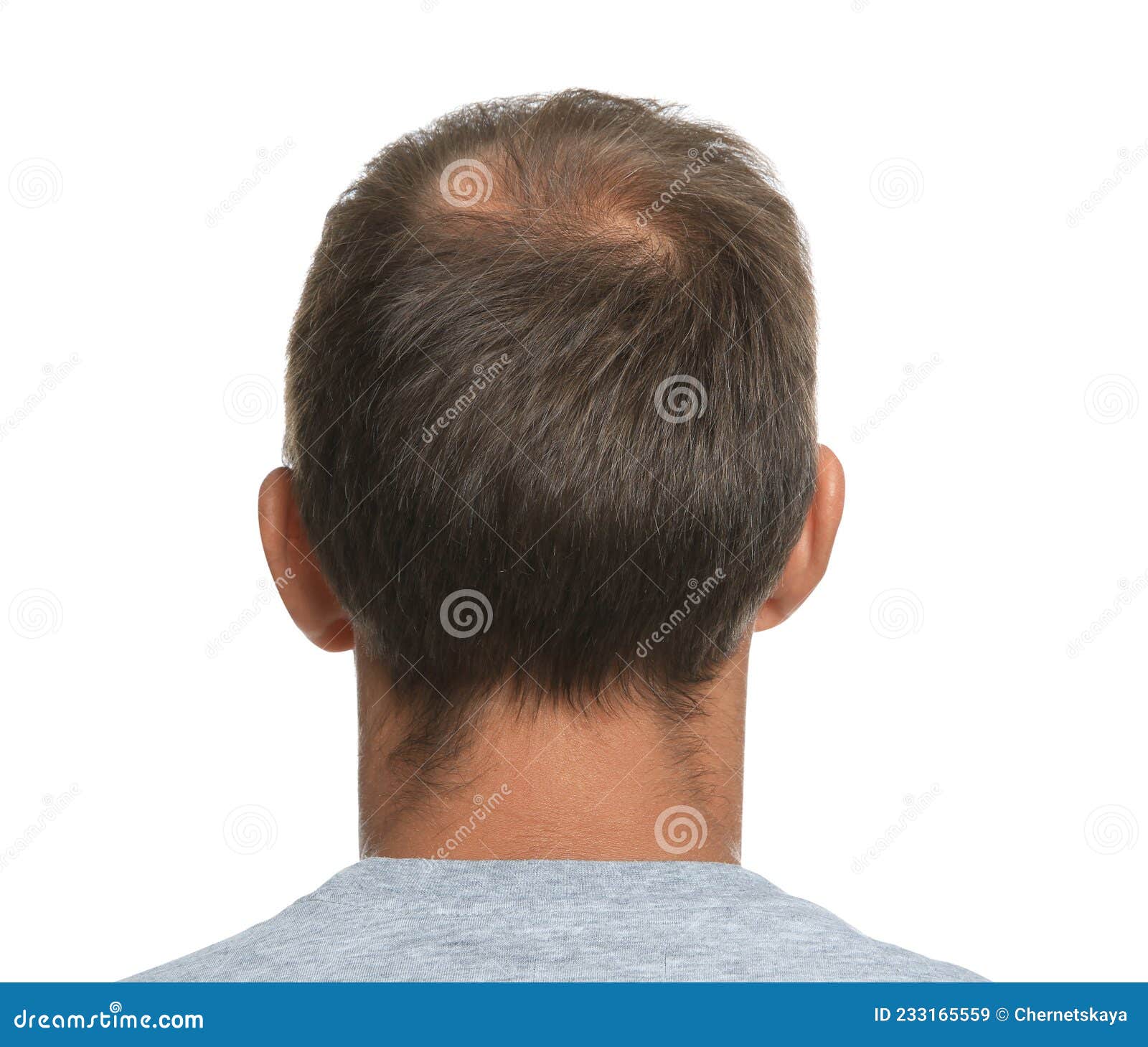 Man with Hair Loss Problem on White Background, Back View Stock Image ...