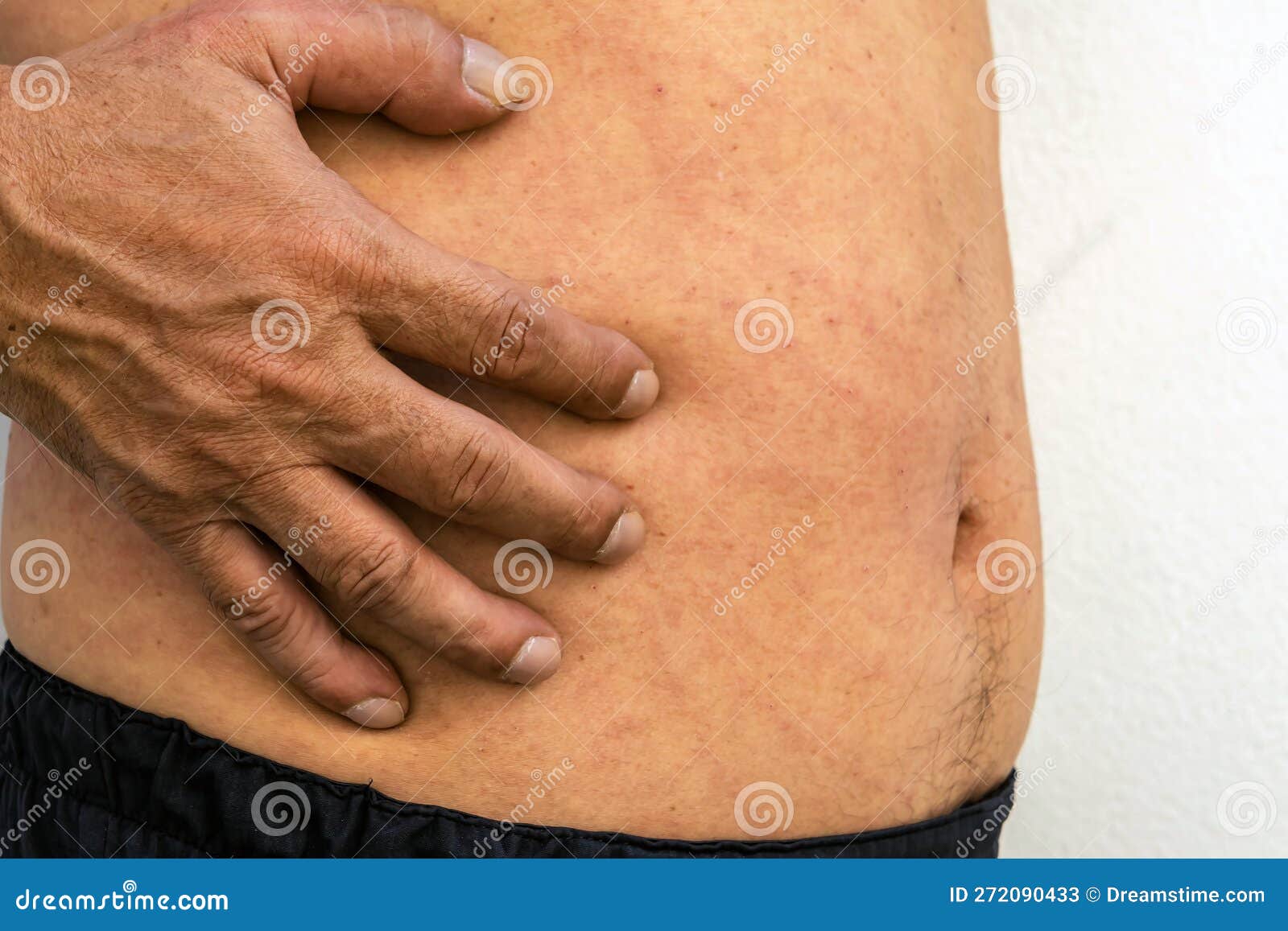 Man Hand Scratching An Itch On Red Mark Sensitive Skin Male Torso With Red Allergic Rash On