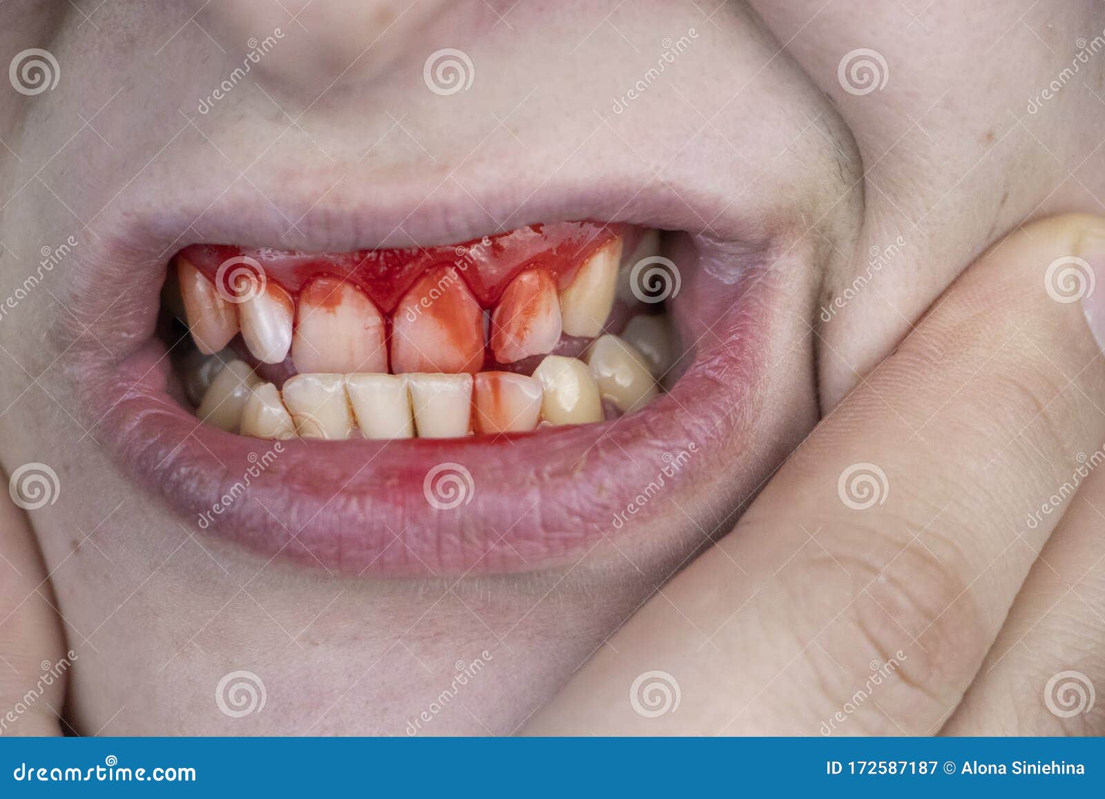 The Man Has Blood on His Teeth, Severe Bleeding of the Gums after a ... The Man Has Blood on His Teeth, Severe Bleeding of the Gums after a ...