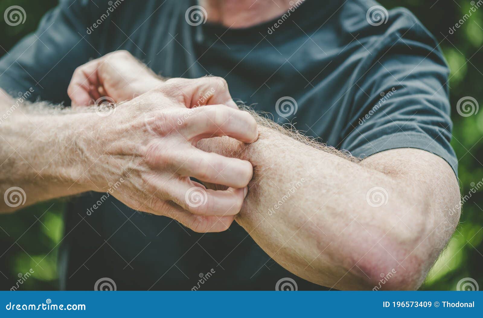 Man scratching his arm stock image. Image of rash, mosquito - 196573409