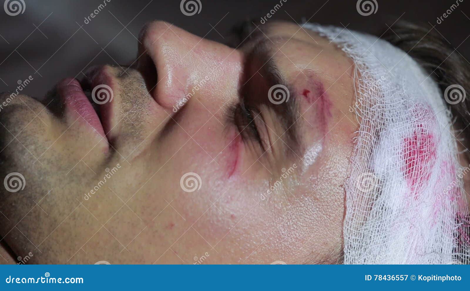 Man with Head Injuries Lying on the Bed. Bandaged Head. Bruise on His ...
