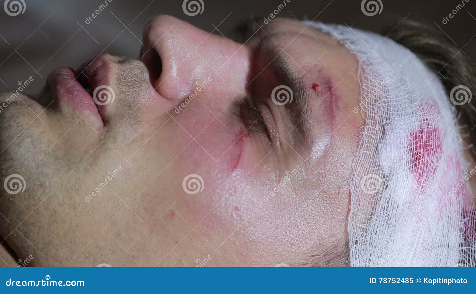 Man with Head Injuries Lying on the Bed. Bandaged Head. Bruise on His ...
