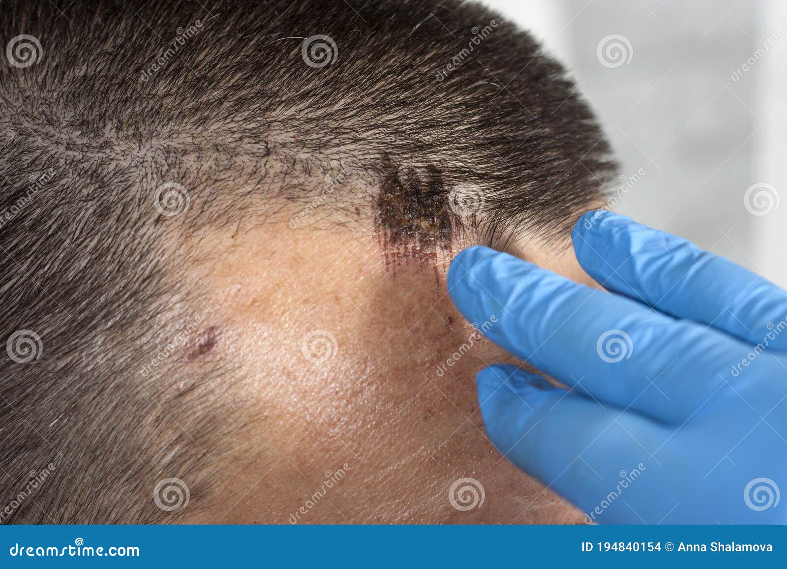 Man with a Head Wound at the Doctor`s Appointment Stock Photo - Image ...