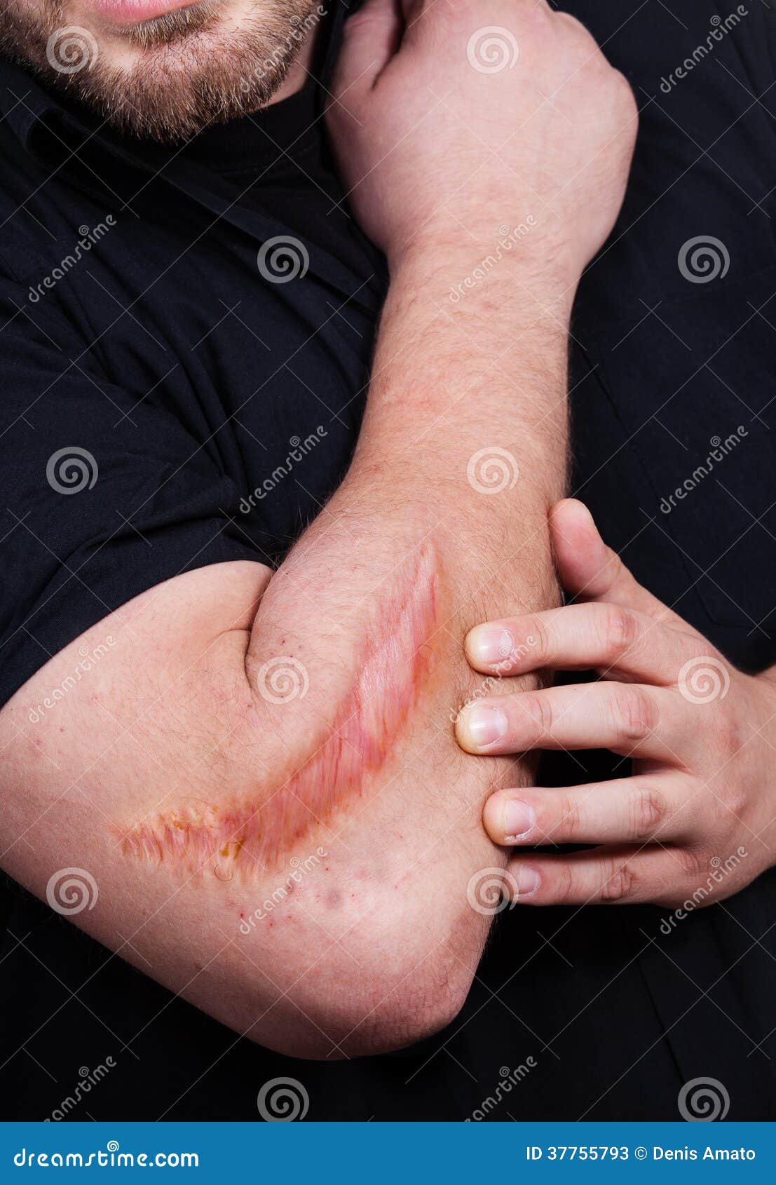 Man with Heavy Scar on His Arm Stock Image - Image of burn, accident ...
