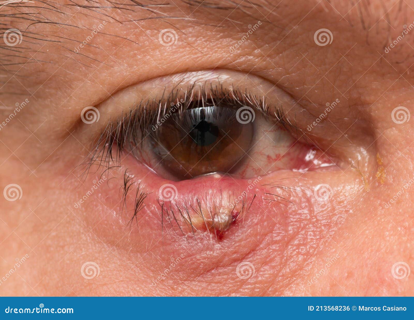 Man with Stye on Eye stock photo. Image of huge, eyebrow - 213568236