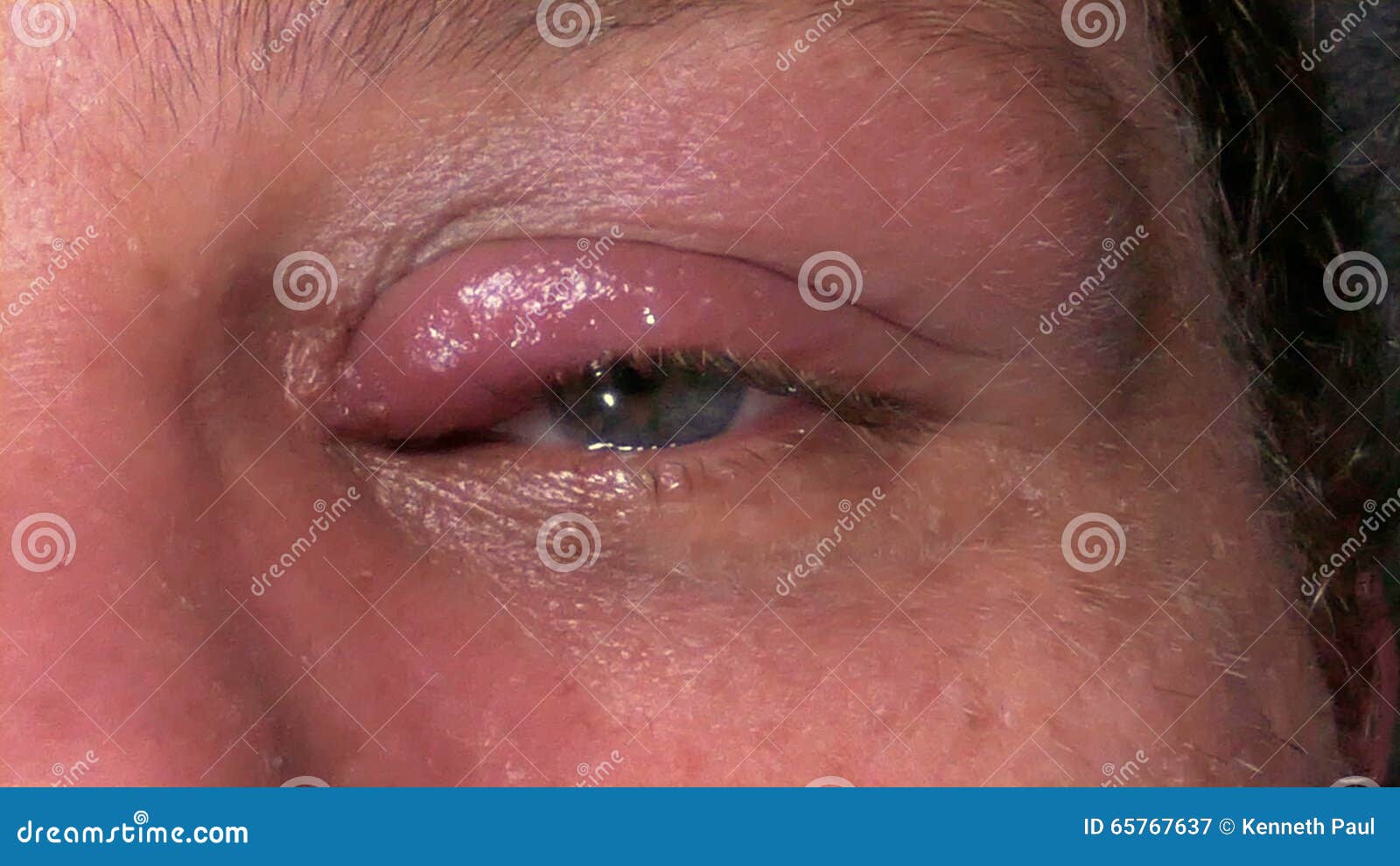 Man with infected eye stock video. Video of caucasian - 65767637