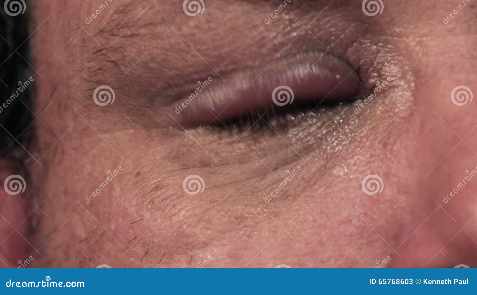 Man with infected eye stock video. Video of barley, eyelid - 65768603
