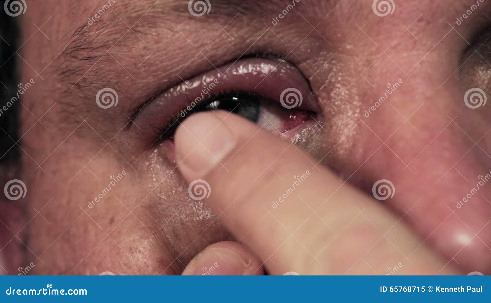 Man with infected eye stock video. Video of externum - 65768715