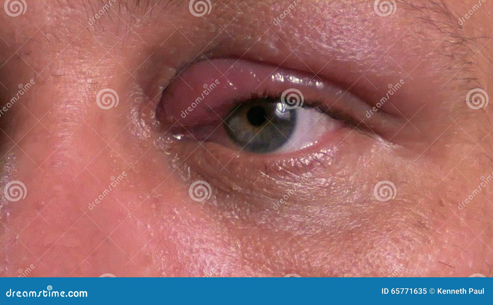 Man with infected eye stock video. Video of macro, festering - 65771635