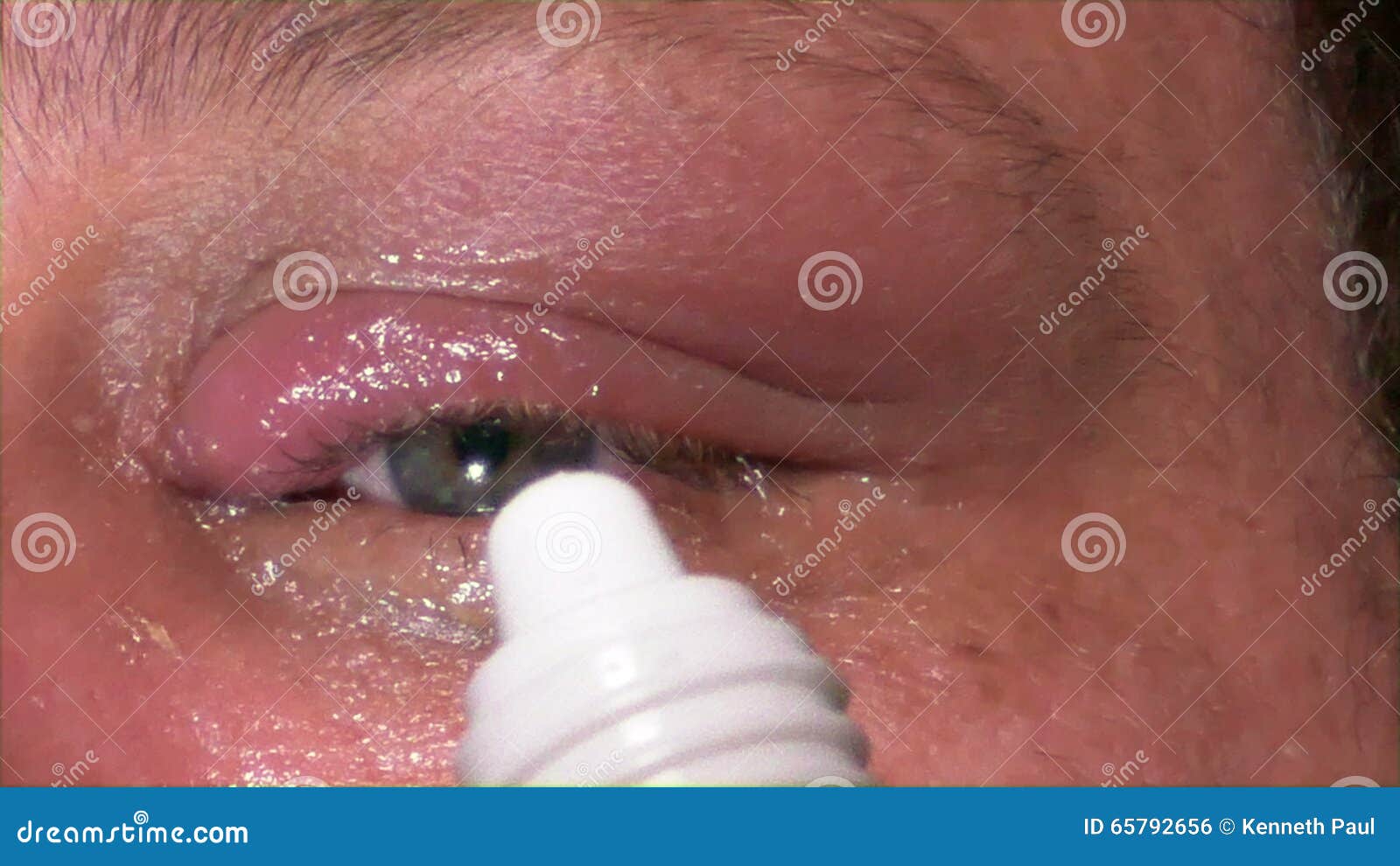 Man with Infected Eye Putting in Eye Drops Stock Footage - Video of ...