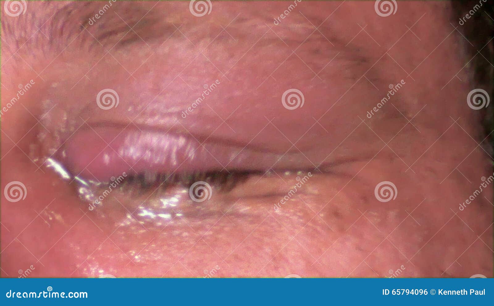 Man with Infected Eye Putting in Eye Drops Stock Footage - Video of ...