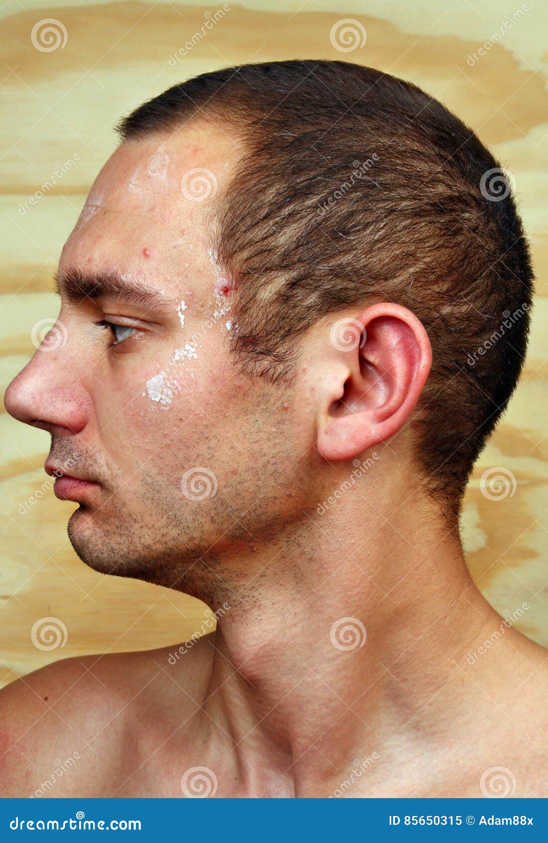 Man with Infected Skin on the Face Stock Image - Image of patient, pain ...