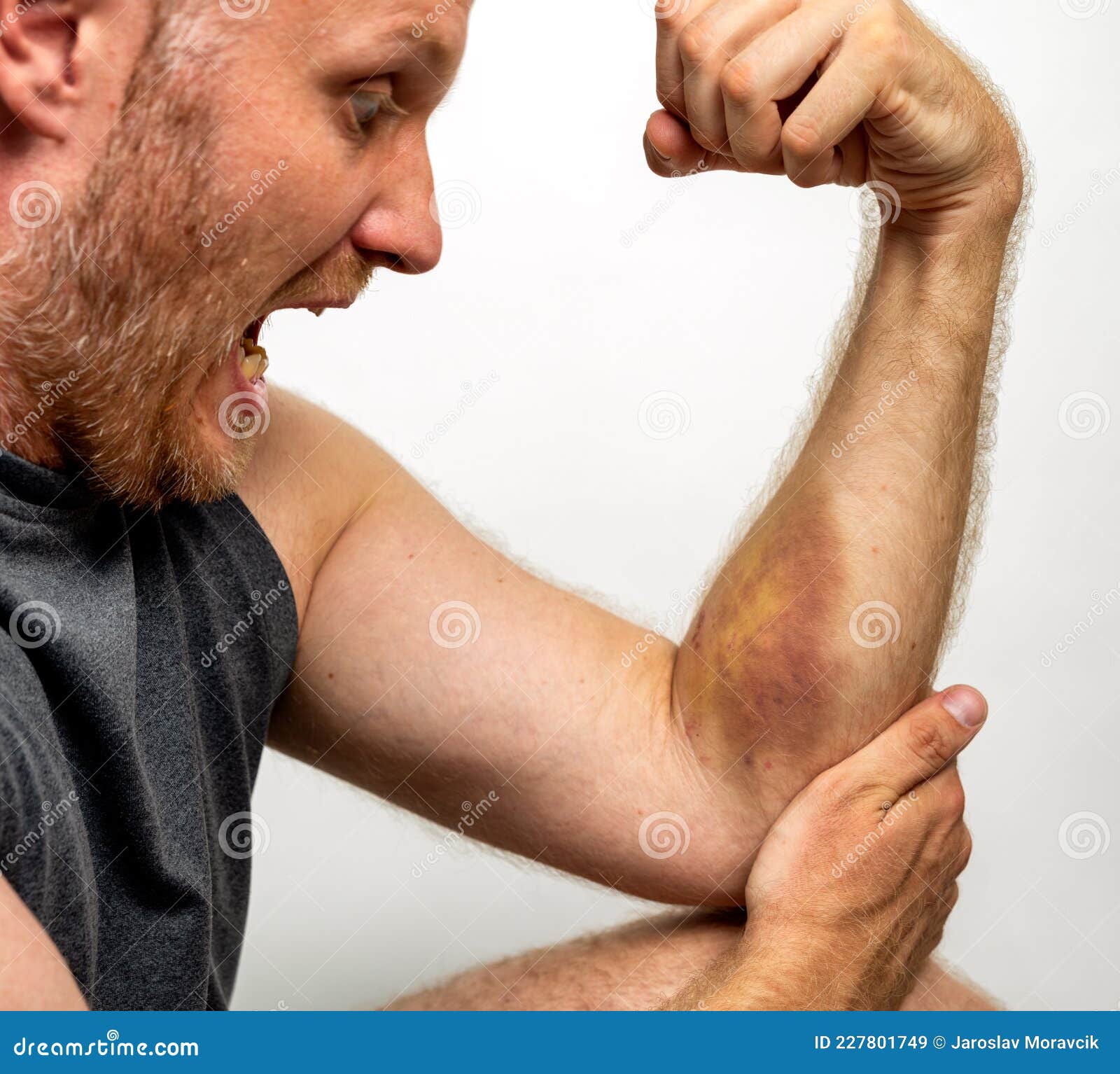 Bruise. Large Bruise. Injection Bruises. Doctor And Patient. Bruised ...