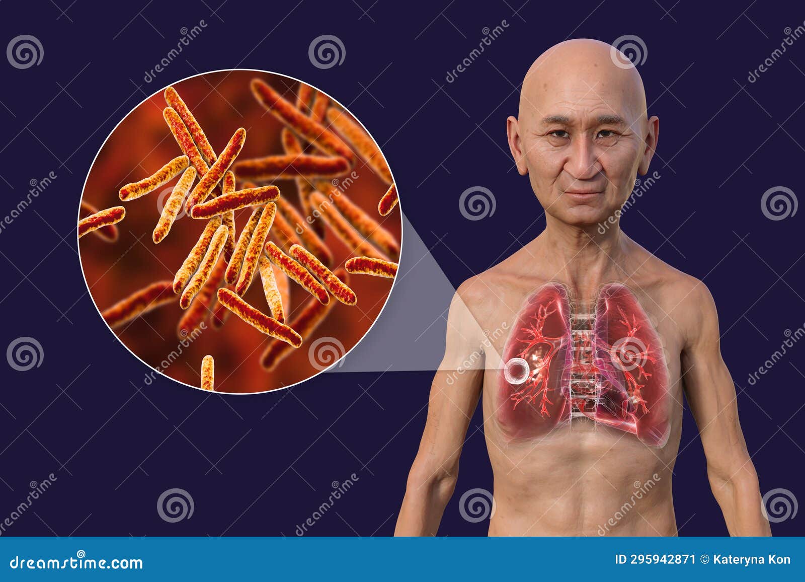 A Man with the Lungs Affected by Cavernous Tuberculosis, and Close-up ...