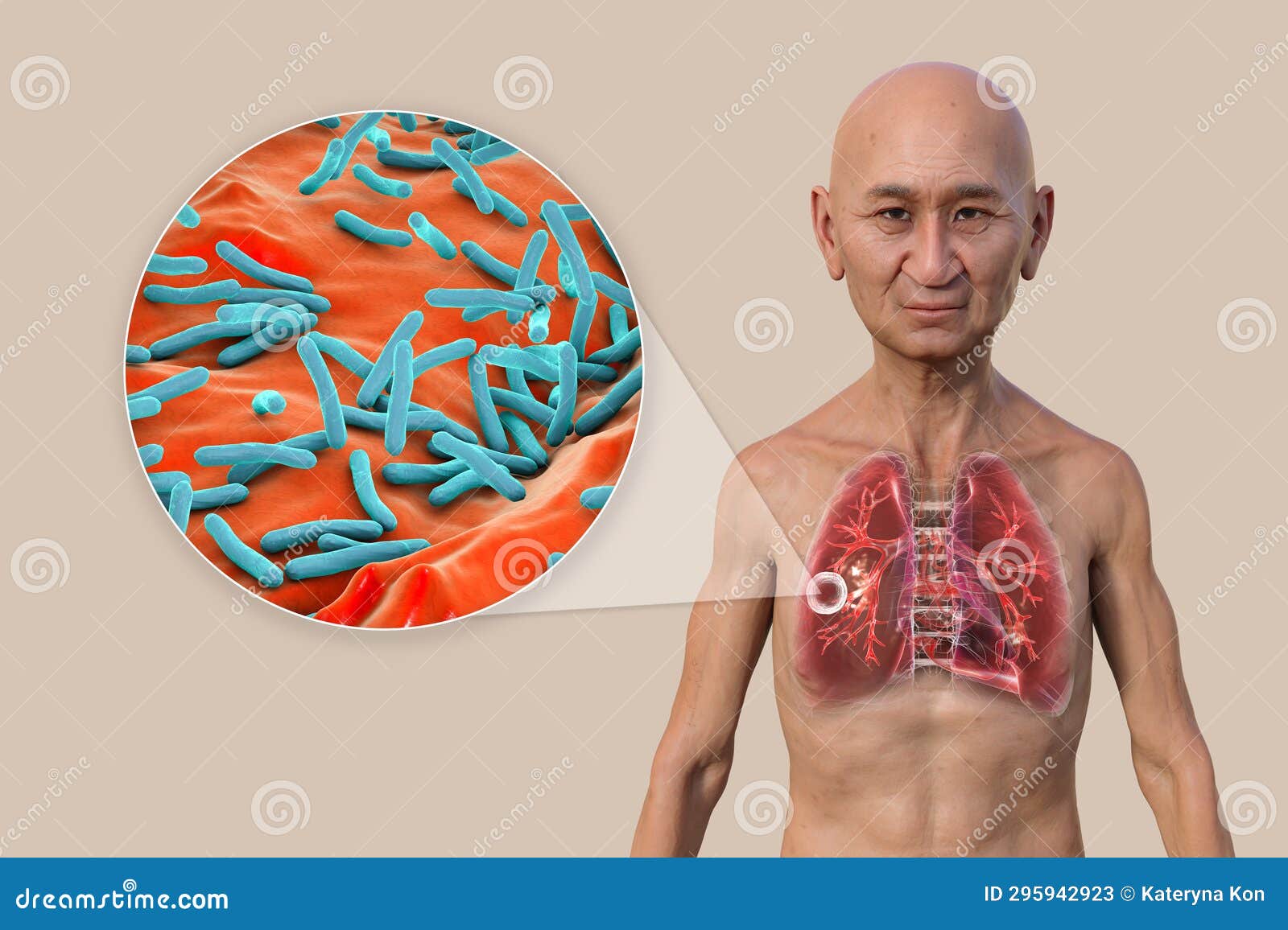 A Man with the Lungs Affected by Cavernous Tuberculosis, and Close-up ...