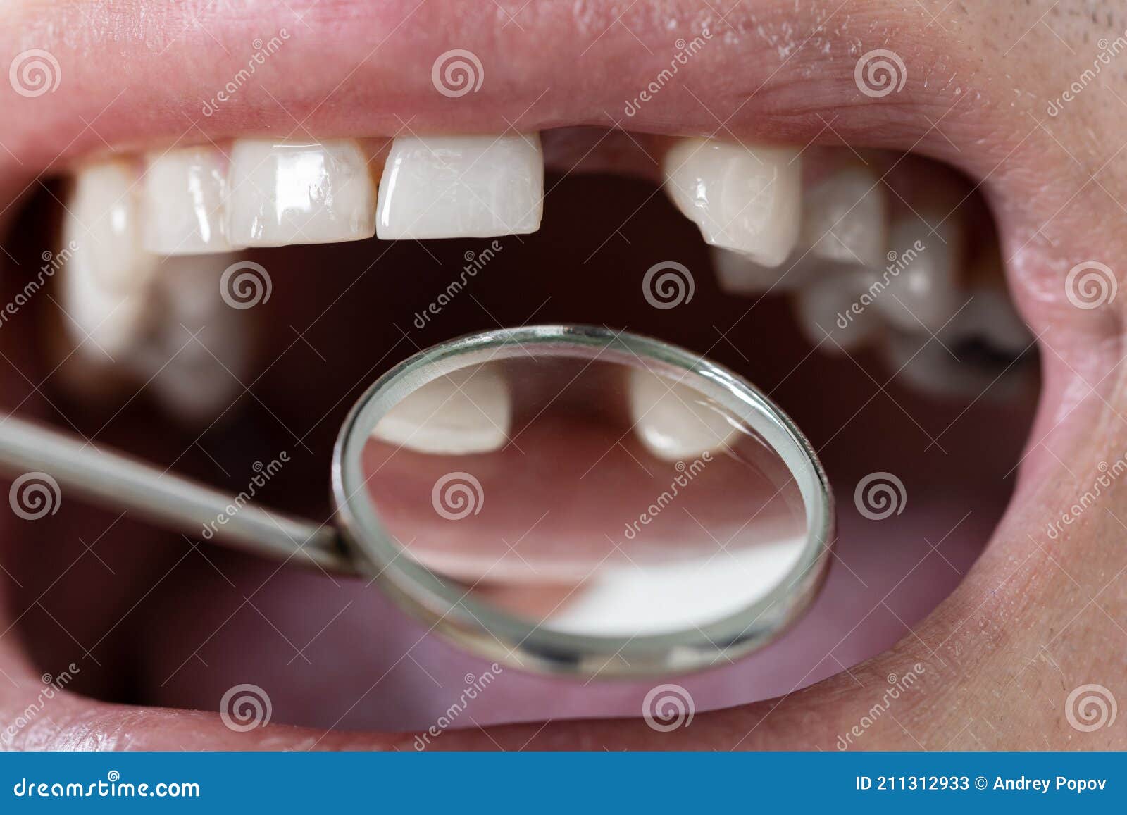 Man with Missing Teeth stock image. Image of white, medications - 211312933