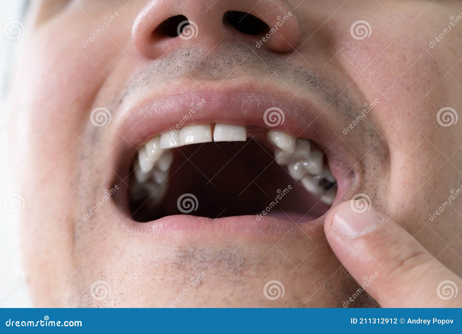 Man with Missing Tooth stock photo. Image of pointing - 211312912