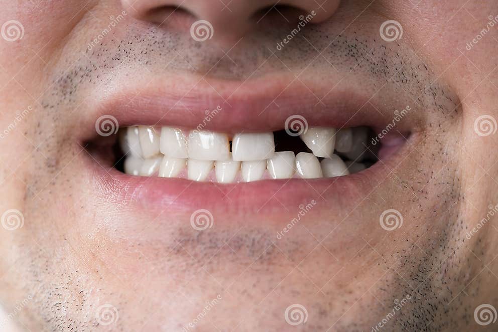 Man with Missing Tooth stock image. Image of medicine - 219157669