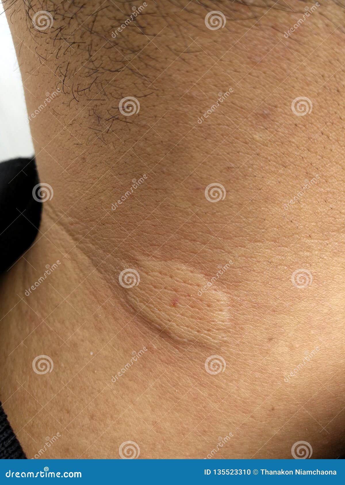 Man neck after bee stings stock photo. Image of girl - 135523310
