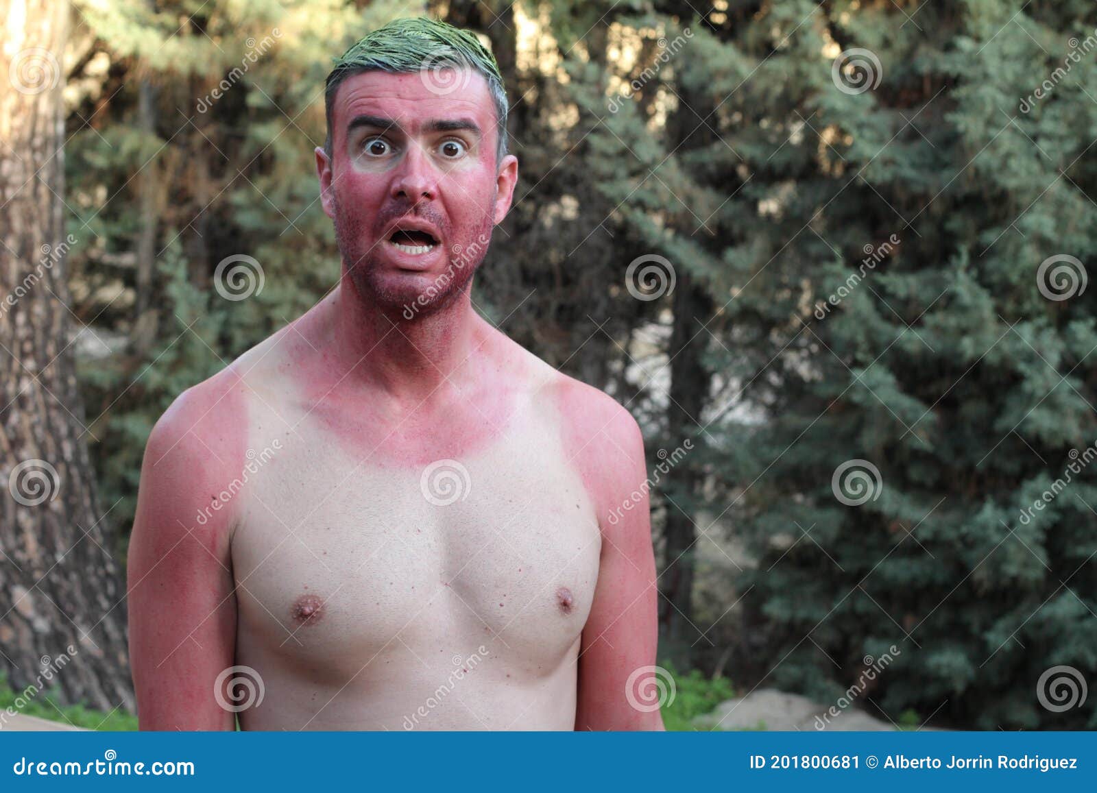 Man with Pale Complexion Getting Sunburnt Stock Image - Image of burnt ...