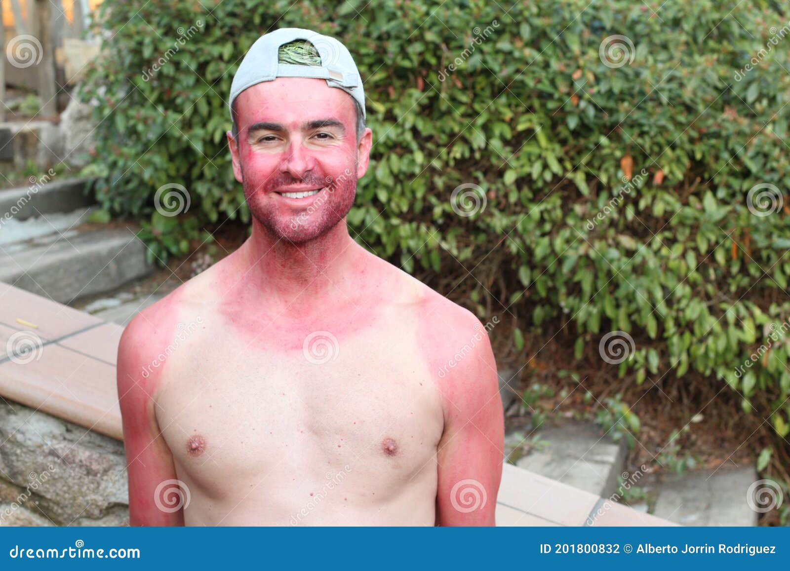 Man with Pale Complexion Getting Sunburnt Stock Photo - Image of funny ...
