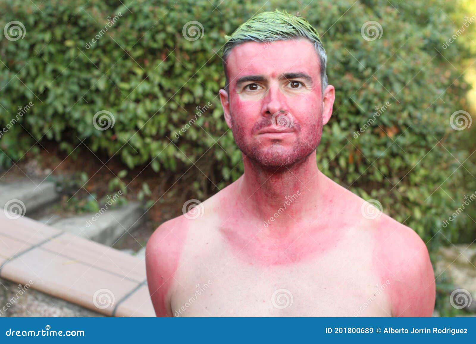 Man with Pale Complexion Getting Sunburnt Stock Image - Image of idiot ...