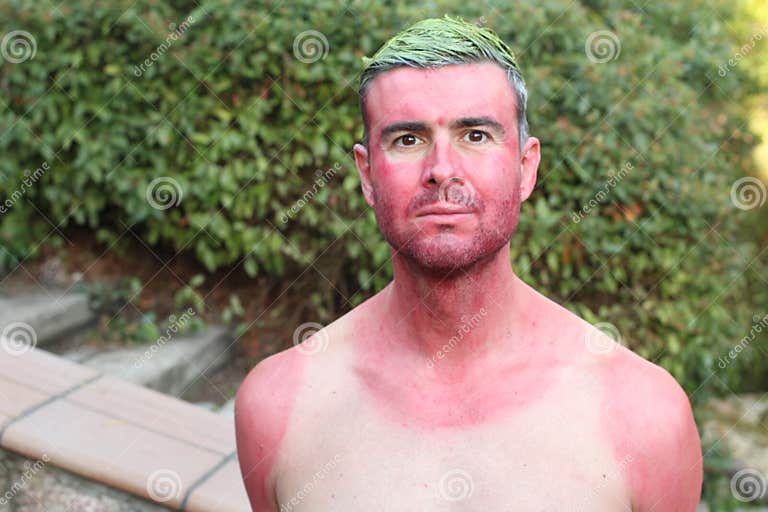 Man with Pale Complexion Getting Sunburnt Stock Image - Image of idiot ...