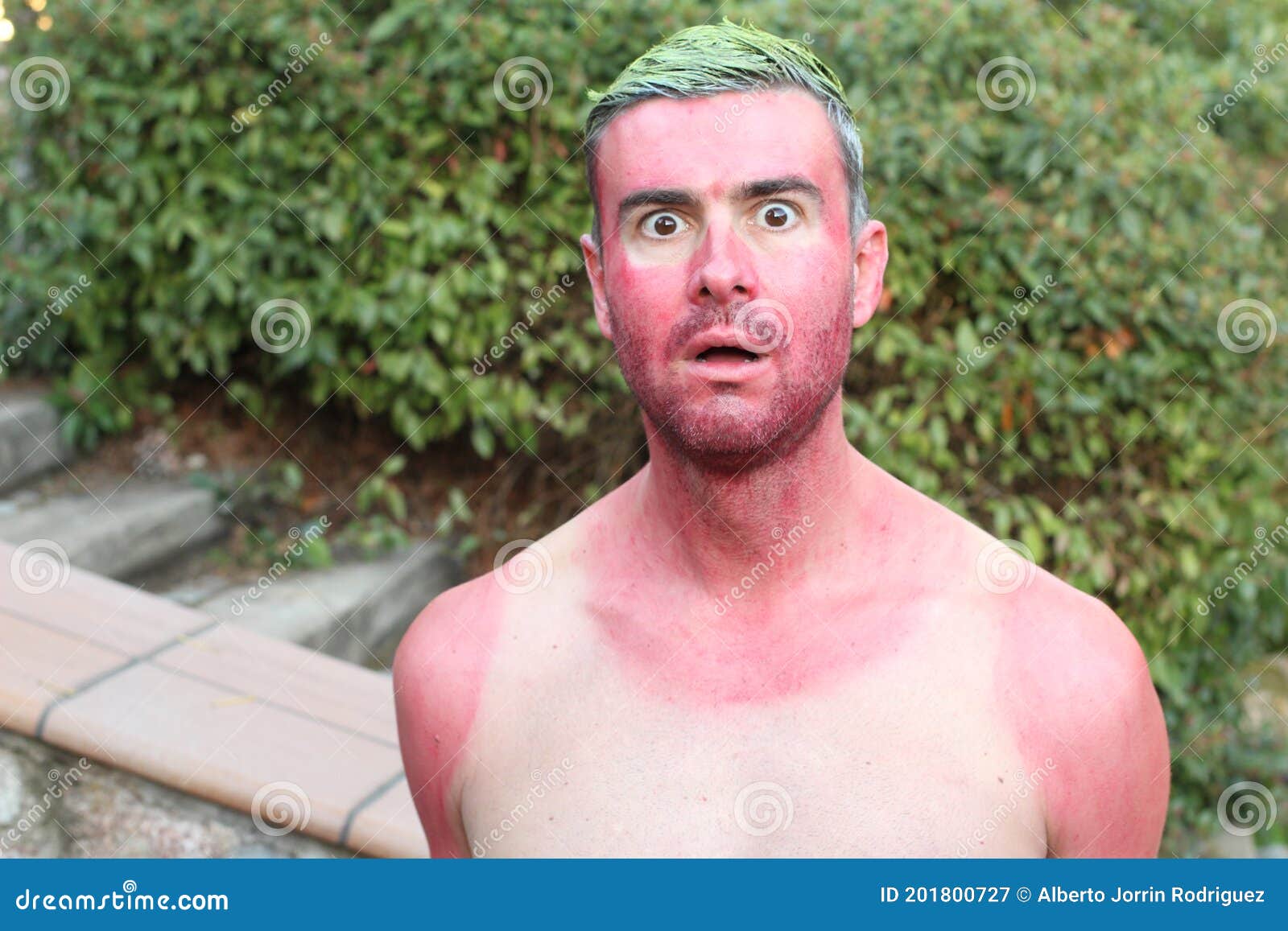 Man with Pale Complexion Getting Sunburnt Stock Image - Image of ...