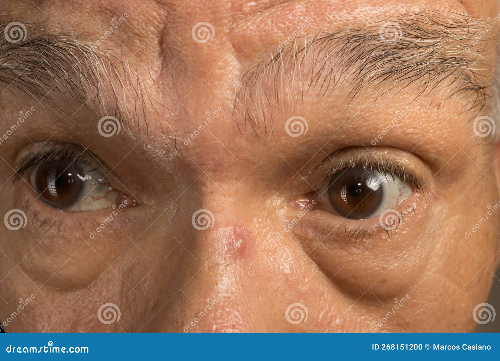 Man with a Pimple on His Nose Stock Photo - Image of hygiene, nose ...