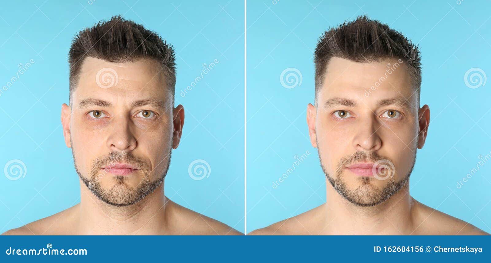 Man before and after Plastic Surgery on Background Stock Photo - Image ...