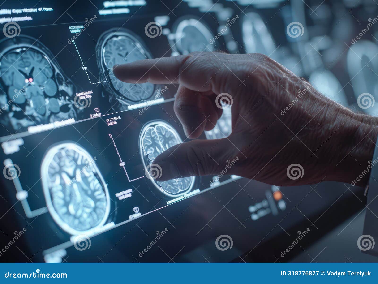 A Man is Pointing at a Brain Scan on a Computer Screen. a Close Up of a ...