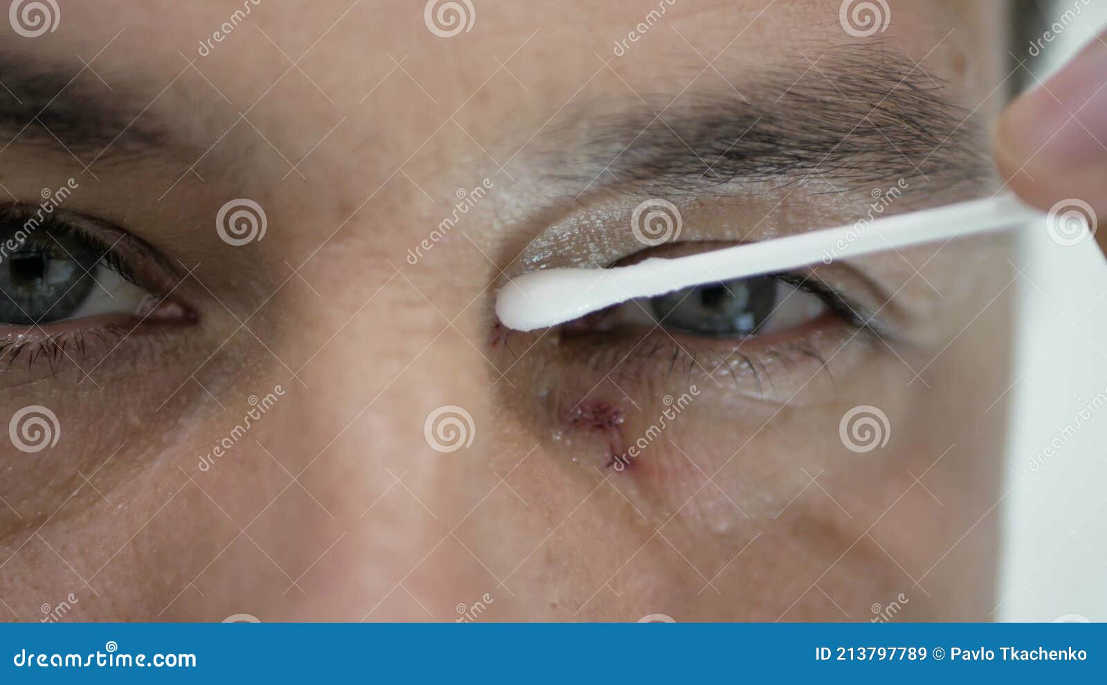 A Man Processes Stitches on a Wound after Surgery Stock Video - Video ...