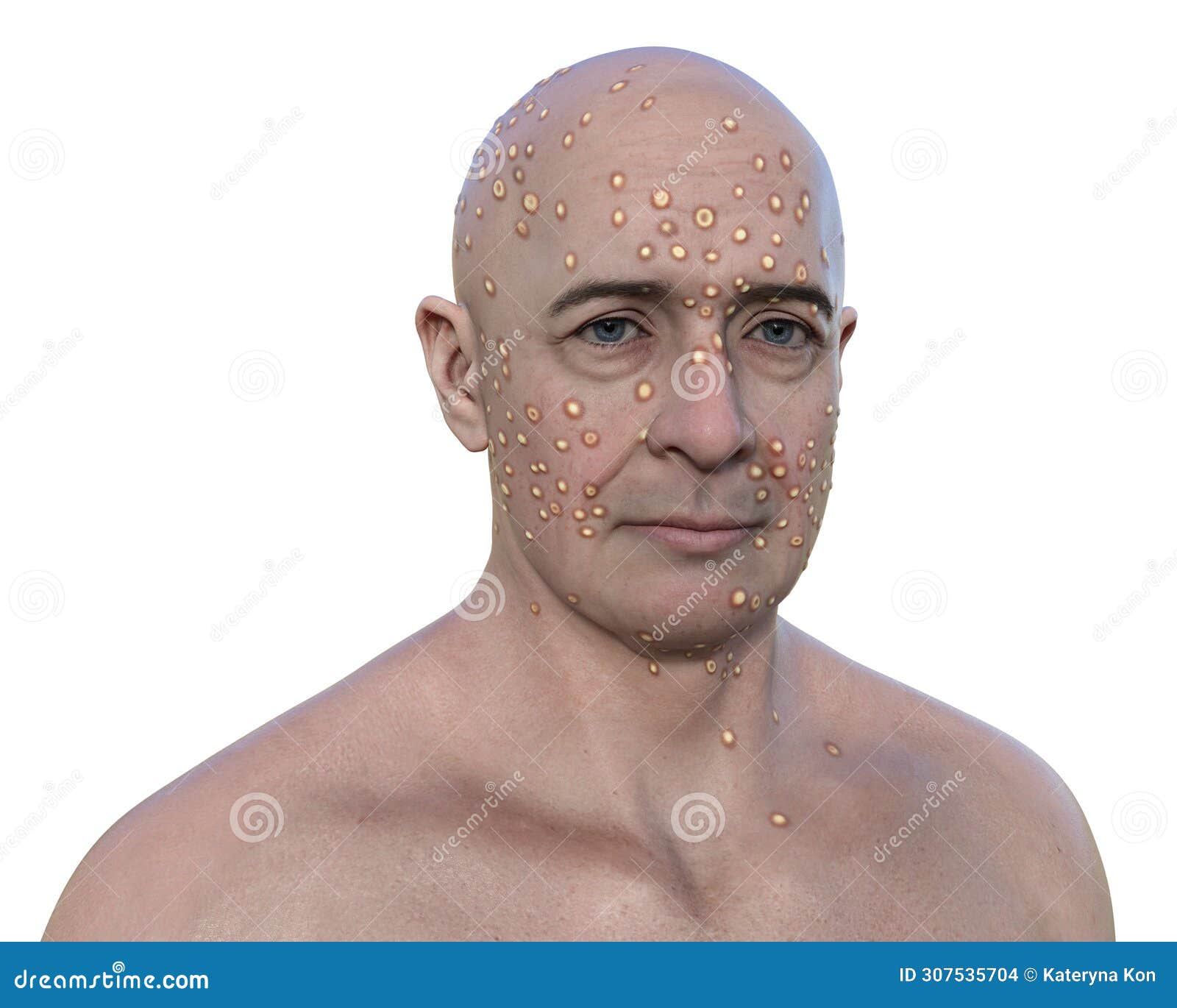 A Man with Rash from Pox Viruses, 3D Illustration Stock Illustration ...