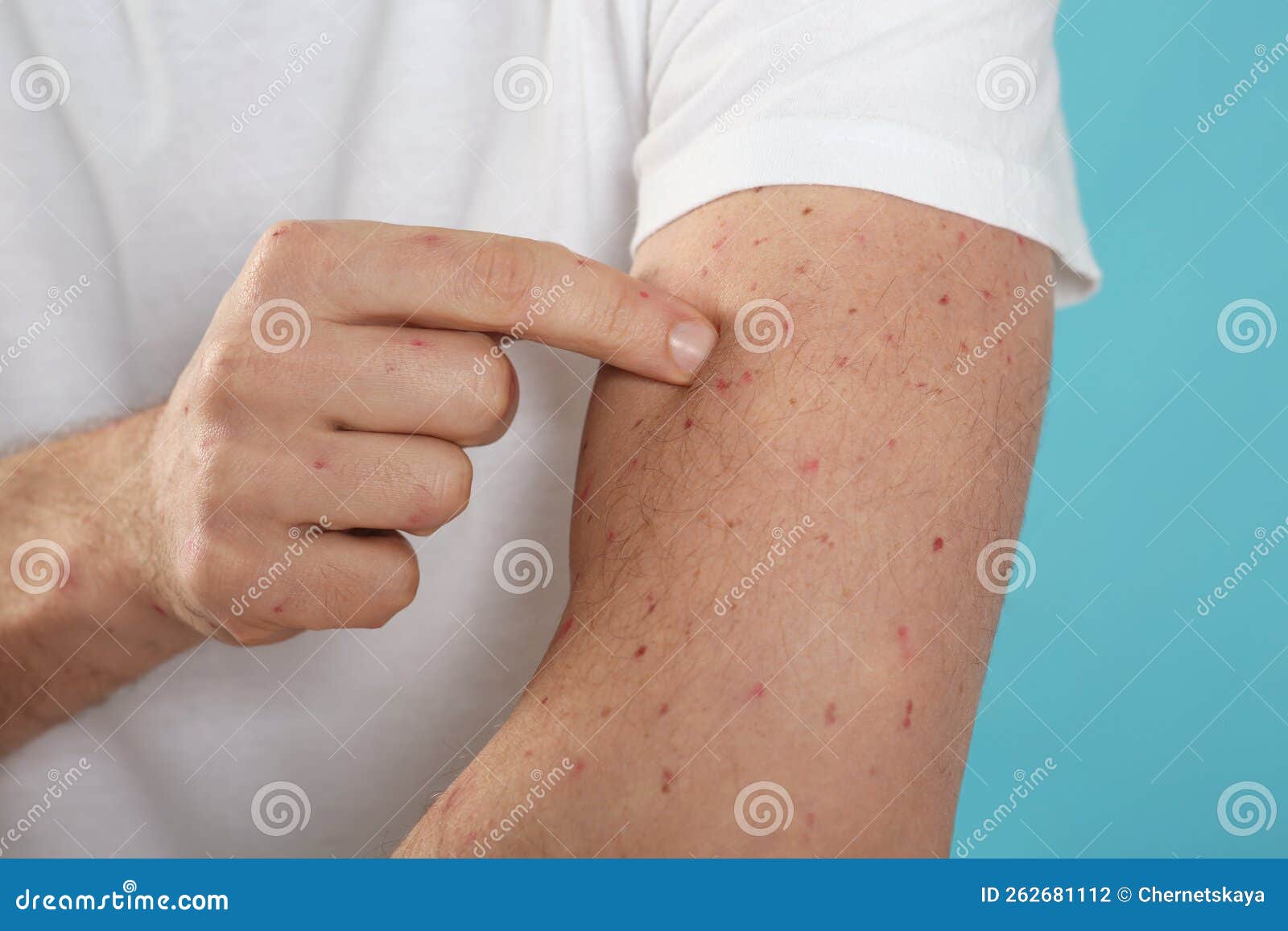 Man with Rash Suffering from Monkeypox Virus on Light Blue Background ...