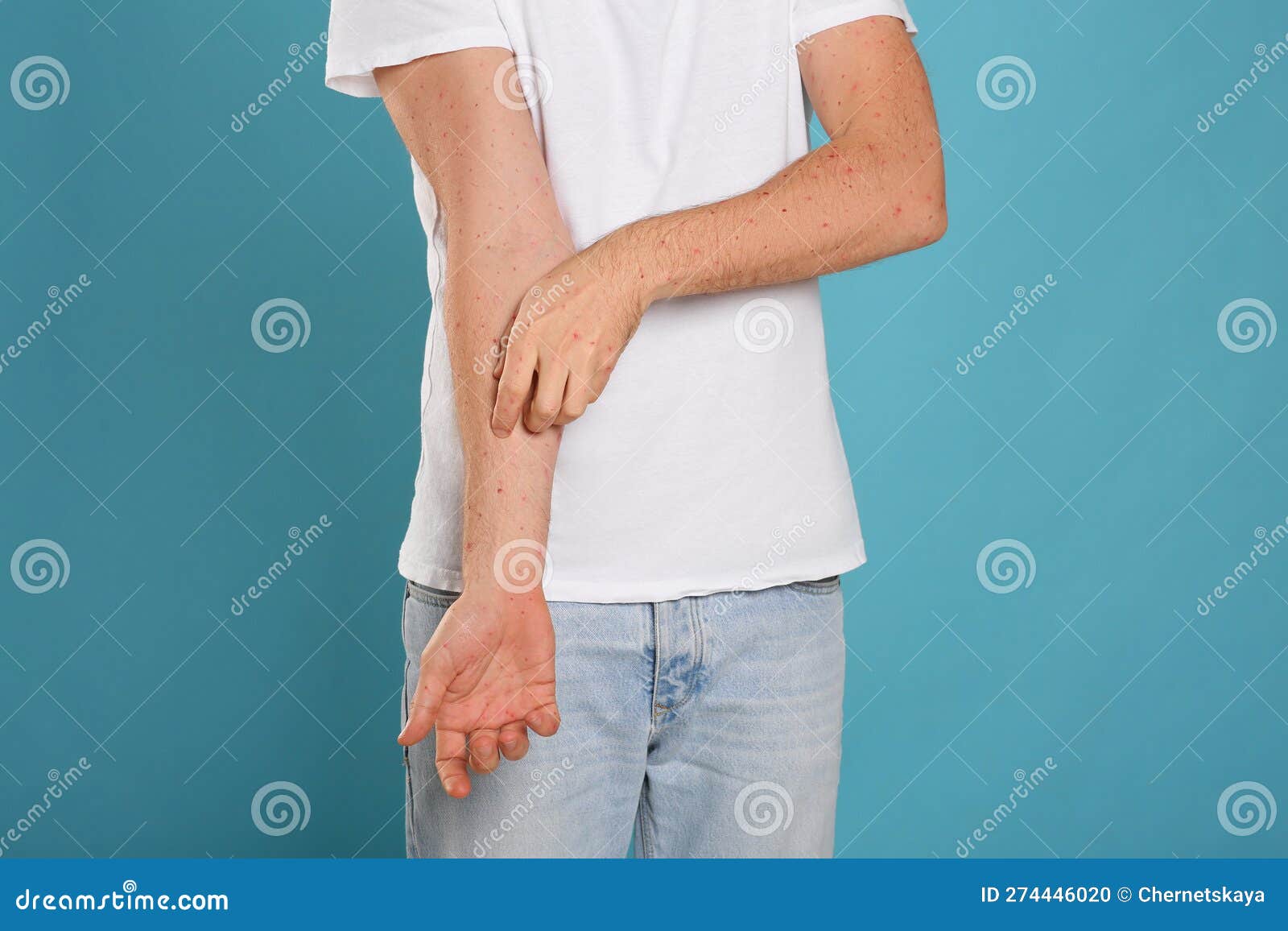 Man with Rash Suffering from Monkeypox Virus on Light Blue Background ...