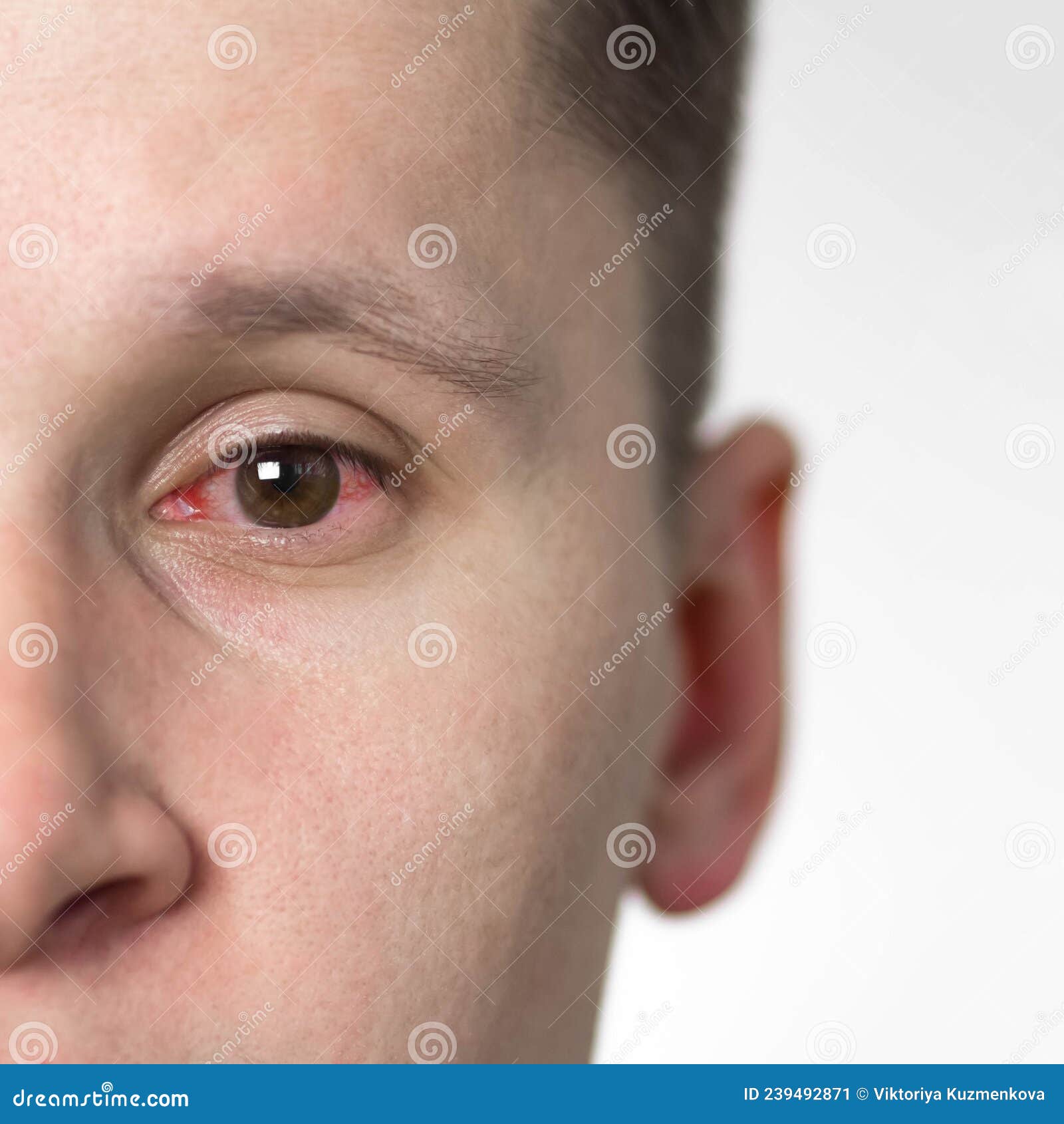 A Man with Red Eyes. Close Up Stock Image - Image of injury, fever ...